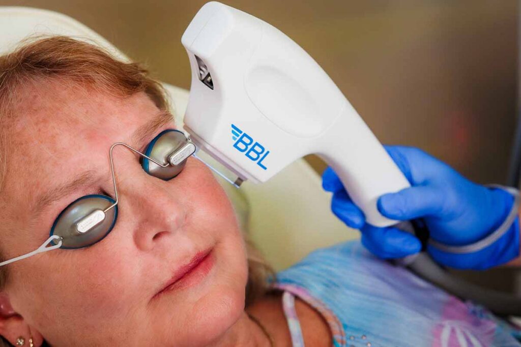 BBL Skin Rejuvenation in Palm Coast, FL | Amethyst Wellness